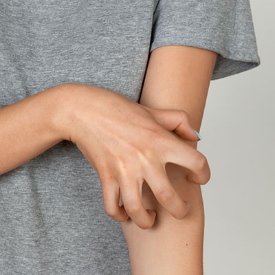 How to avoid insect bites? - Recotin - Fast relief after bite